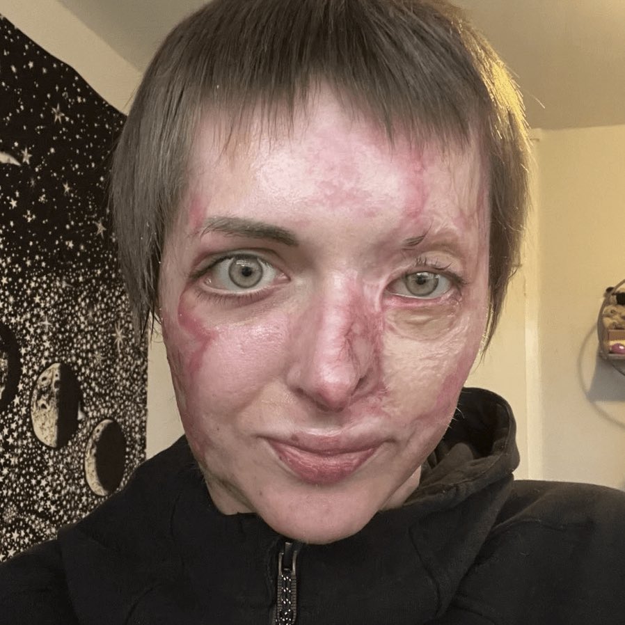 @salmoona_ Half face partially healed burn victims Granted, I dont ...