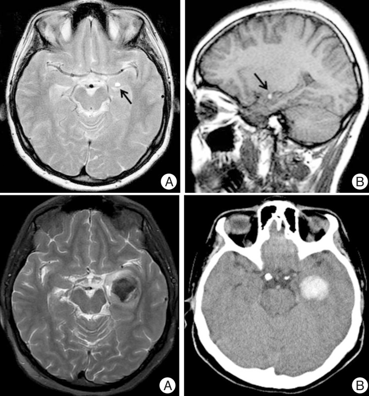Hemorrhagic choroidal fissure cyst. 💡These benign CSF-containing ...