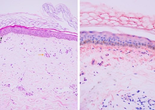 This is systemic AL (light-chain) amyloidosis presenting w/ the ...