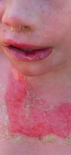 𝐖𝐚𝐫𝐧𝐢𝐧𝐠 𝐟𝐨𝐫 𝐩𝐚𝐫𝐞𝐧𝐭𝐬: ‼️ ⚠️ A 4-year-old girl suffered severe chemical ...