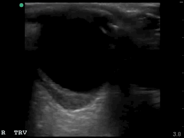 Retrobulbar Hematoma