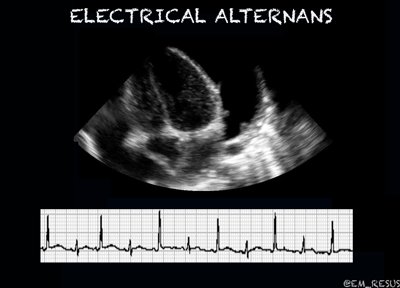 Electrical Alternans