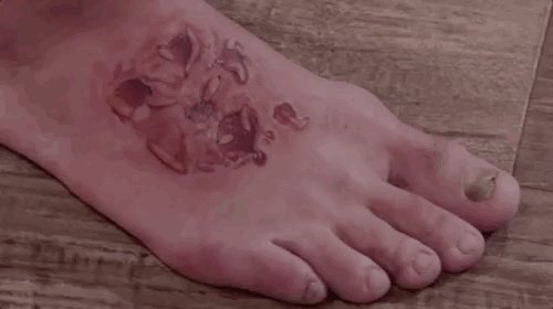 Maggots In Foot Gif
