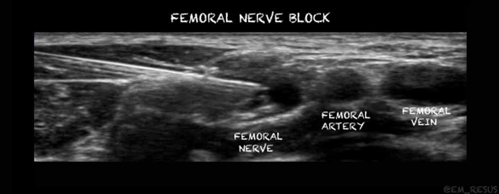 Femoral Nerve Block