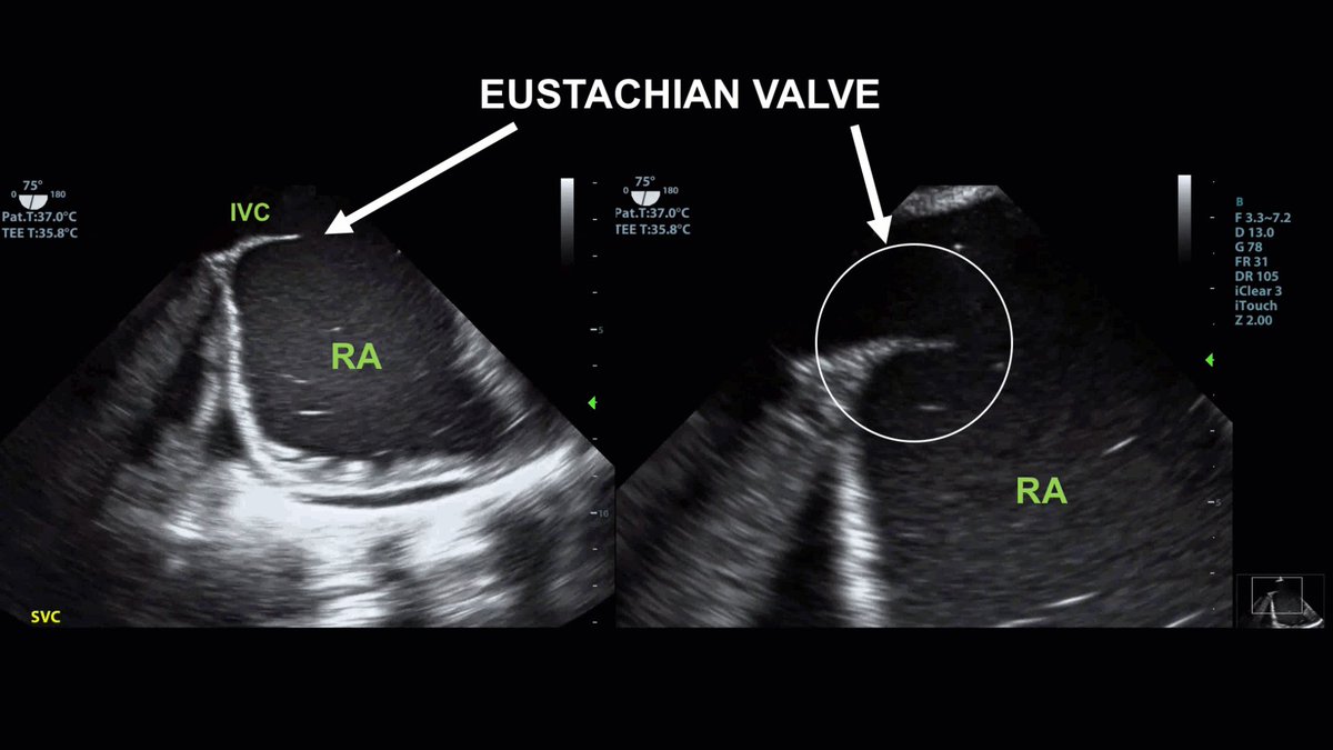 Eustachian Valve Tee