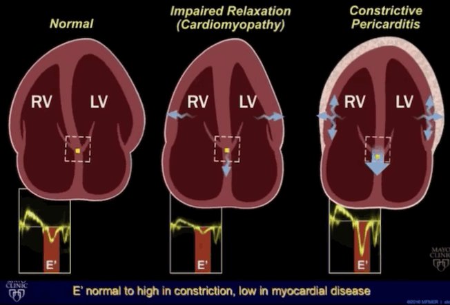 Constrictive Pericarditis
