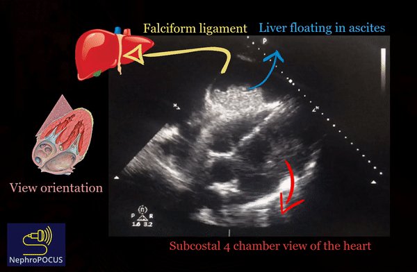 Falciform Ligament Ultrasound