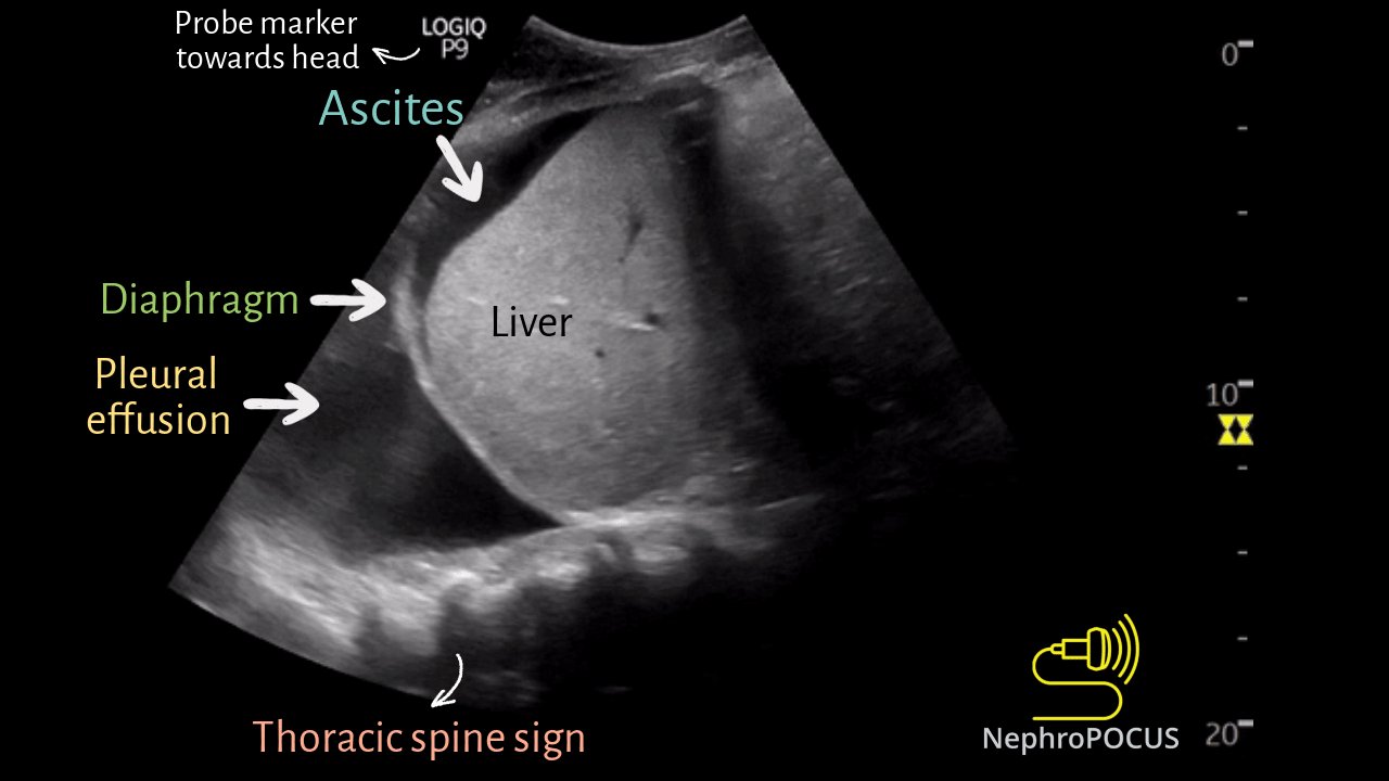 Ascites Vs Pleural Effusion Ultrasound