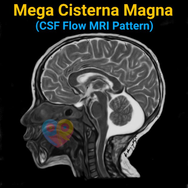 Cisterna Magna Anatomy