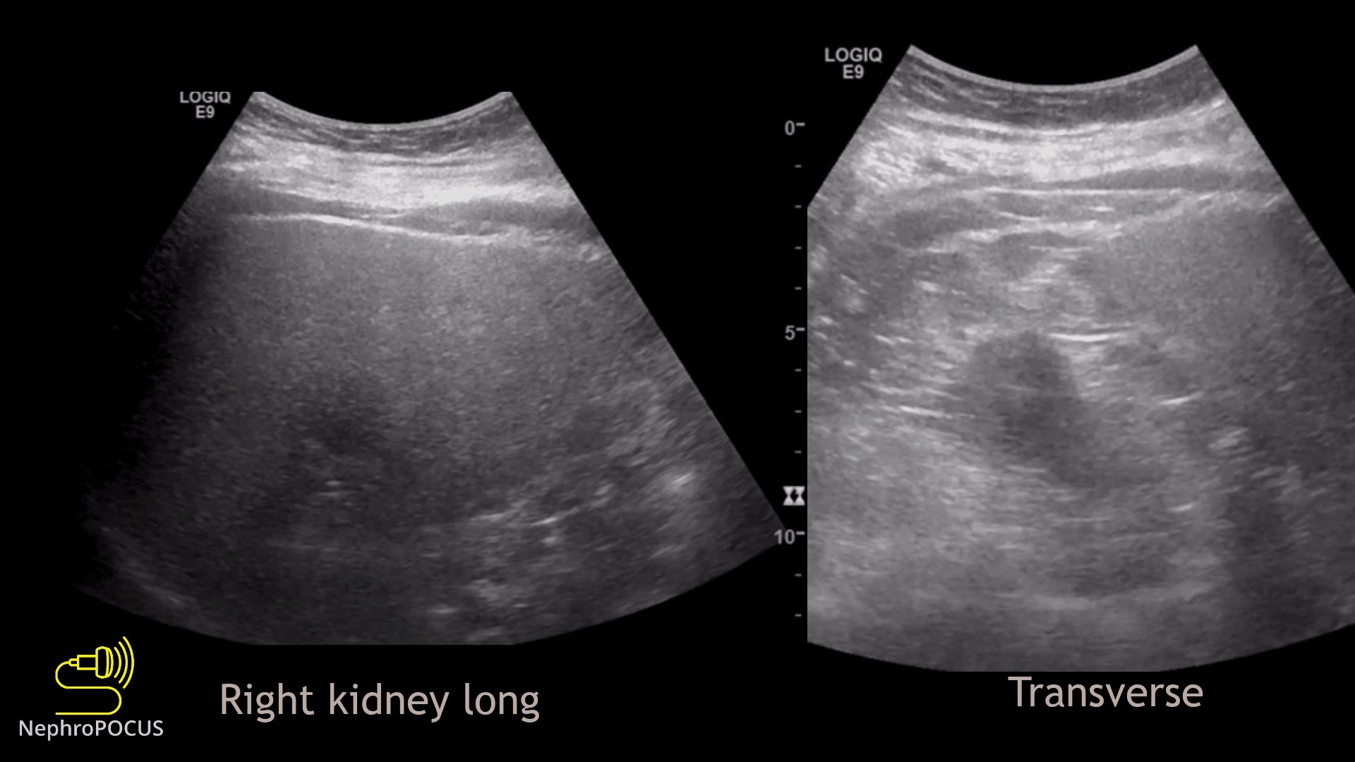 Kidney Ultrasound